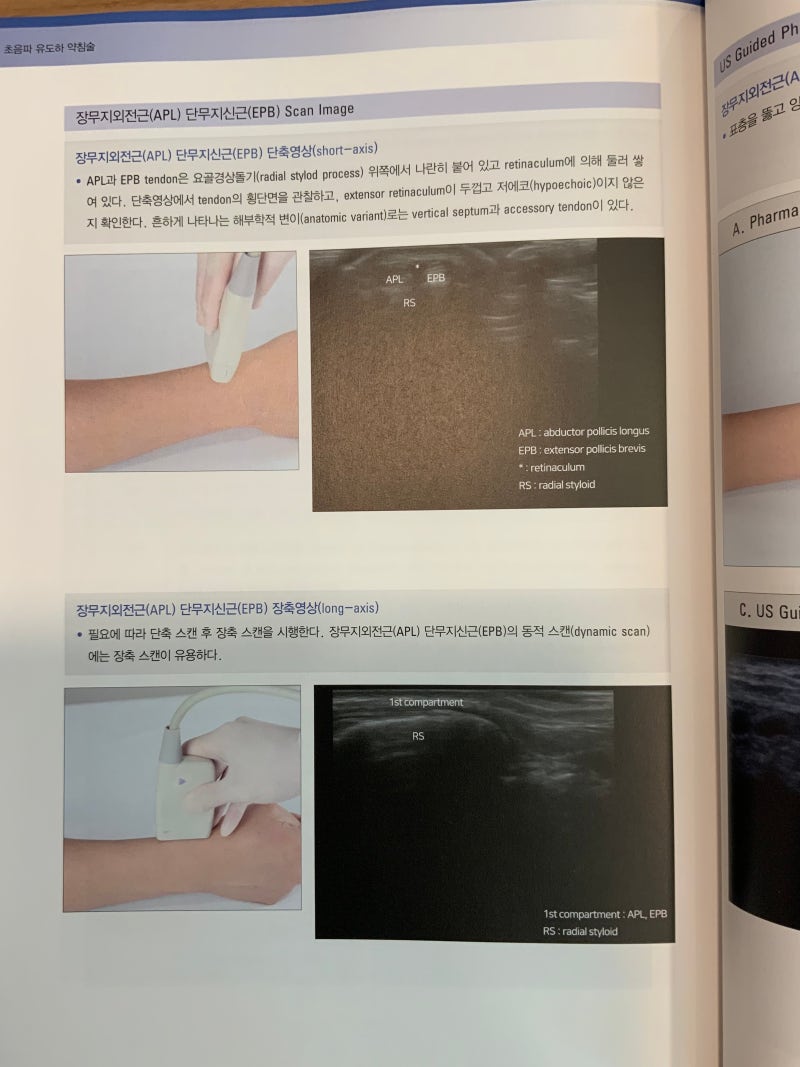 드퀘르뱅 손목 건초염 생기는 이유 네이버 블로그
