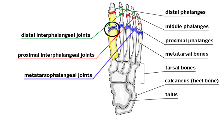 류마티스관절염 분류기준에서 PIP, MCP, IP, MTP : 네이버 블로그