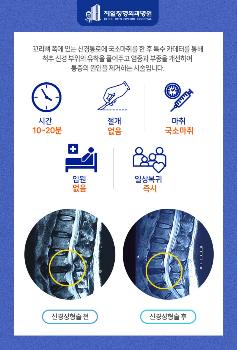 척추관협착증 비수술적 치료방법인 신경성형술에 대해 알려드립니다 Feat 척추센터 김재훈 원장 네이버 블로그