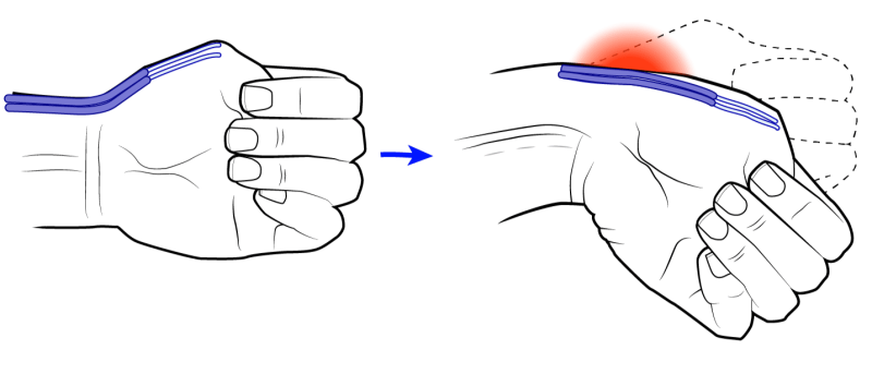 손목건초염 드퀘르뱅 증후군dequervain Syndrome 원인 증상 치료 네이버 블로그