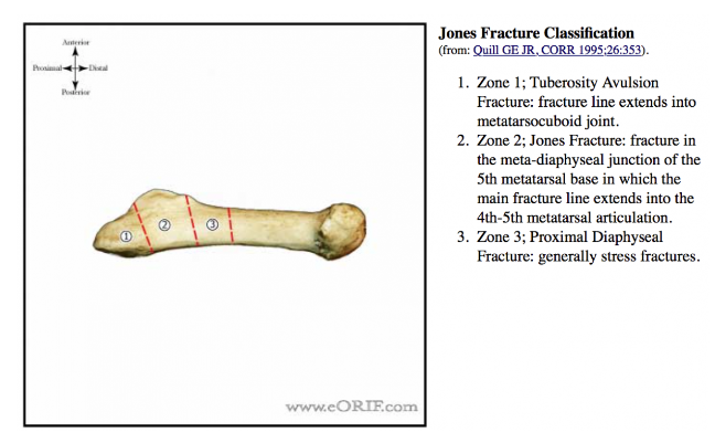 [황재웅 원장 칼럼] 제5 중족골 기저부 골절; The 5th metatarsal Base Fracture; Jones ...