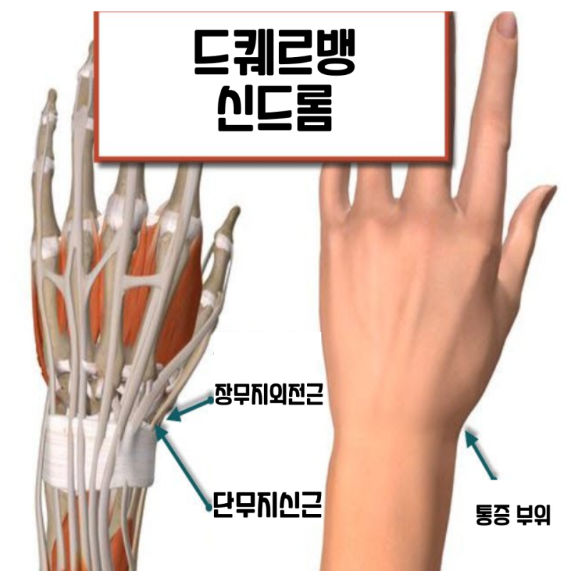 손목건초염 드퀘르뱅 증후군dequervain Syndrome 원인 증상 치료 네이버 블로그