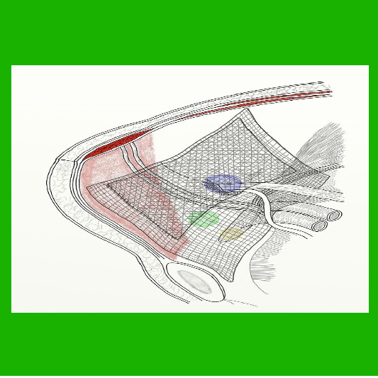 Herniorrhaphy inguinal hernia repair 수술 준비 및 수술 과정 : 네이버 블로그