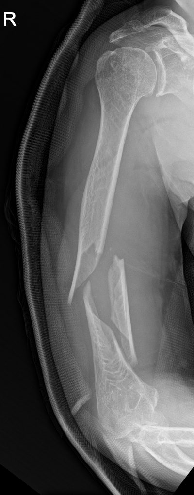 상완골 간부 분쇄골절 (Humerus shaft Fracture)의 올바른 수술적 치료 방법 (수술 후 재활 및 경과 ...