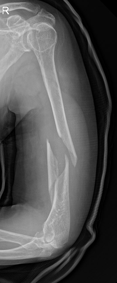 상완골 간부 분쇄골절 Humerus Shaft Fracture의 올바른 수술적 치료 방법 수술 후 재활 및 경과