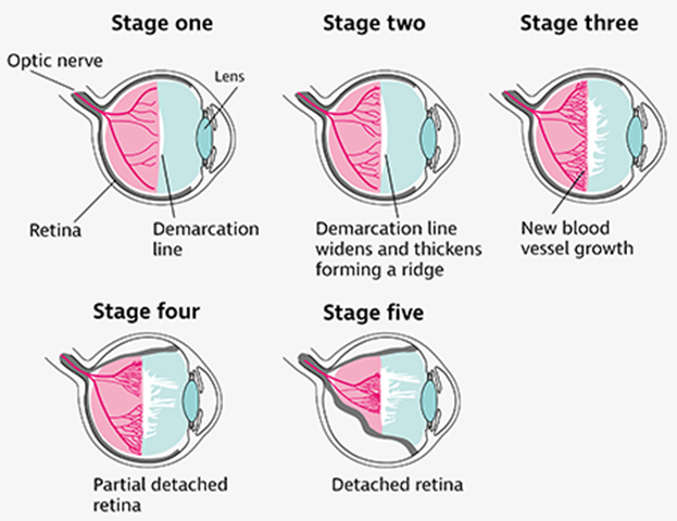 미숙아 망막병증, ROP (Retinopathy of Prematurity) || 신생아 질환 : 네이버 블로그