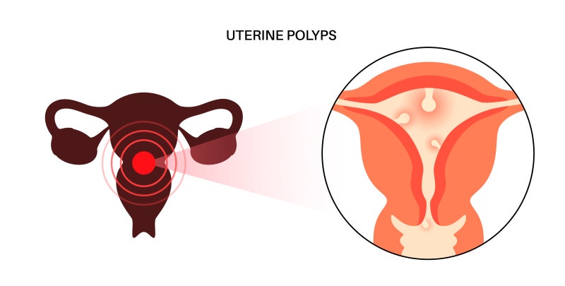 자궁내막암 증상 검사 방법 치료 생존율1기 3기 네이버 블로그