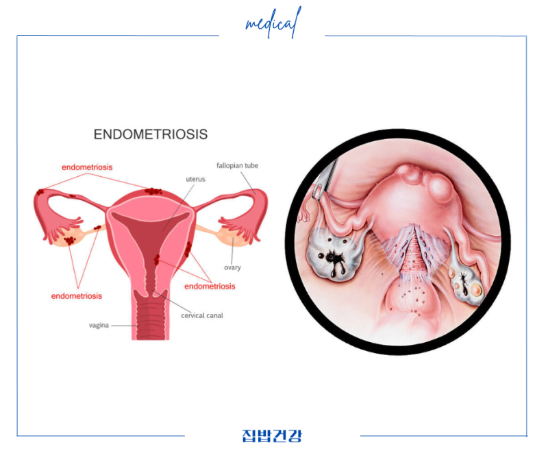 비잔정 자궁내막증 효과 및 부작용 알아보기 네이버 블로그
