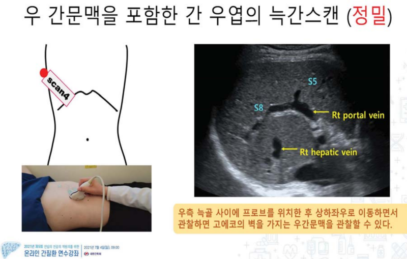 복부 초음파에 대해 알아봅시다 간담낭췌장비장 스캔법 건강검진 네이버 블로그