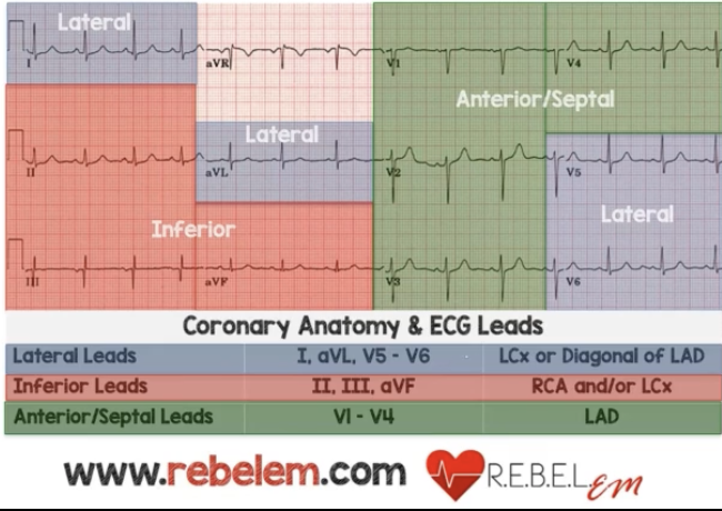 ST 분절 상승 심근경색(STEMI : ST elevation myocardial infarction) : 12 lead ECG ...