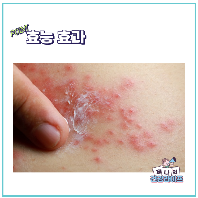 베이드크림 효능과 부작용 가격습진 아토피 땀띠 스테로이드 연고 네이버 블로그