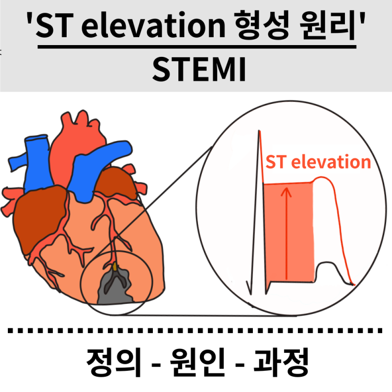 ST 분절 상승 심근경색(STEMI : ST elevation myocardial infarction) : 12 lead ECG ...