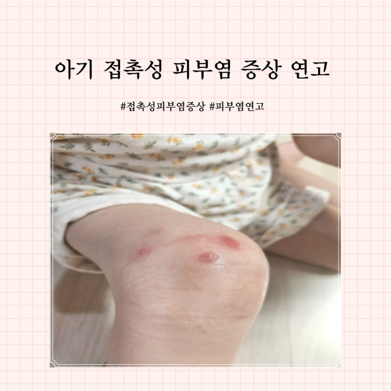 아기 접촉성 피부염 증상 물집 아기 피부염 연고 네이버 블로그