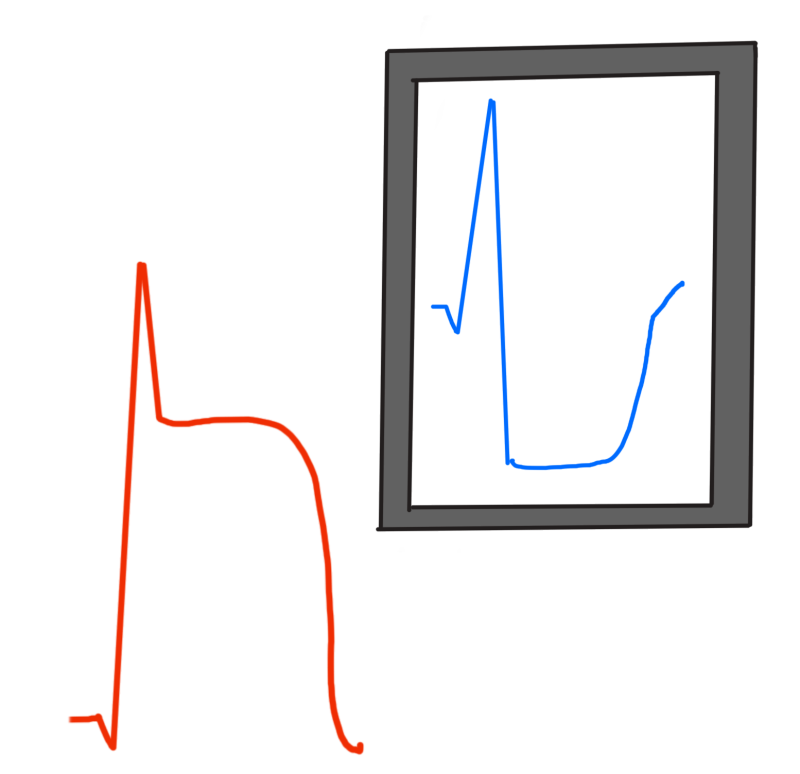 ST 분절 상승 심근경색(STEMI : ST elevation myocardial infarction) : 12 lead ECG ...