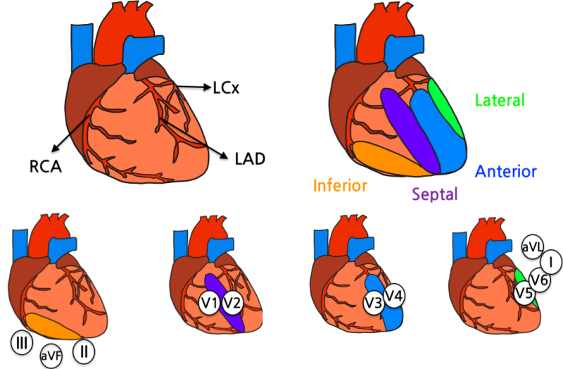 ST 분절 상승 심근경색(STEMI : ST elevation myocardial infarction) : 12 lead ECG ...