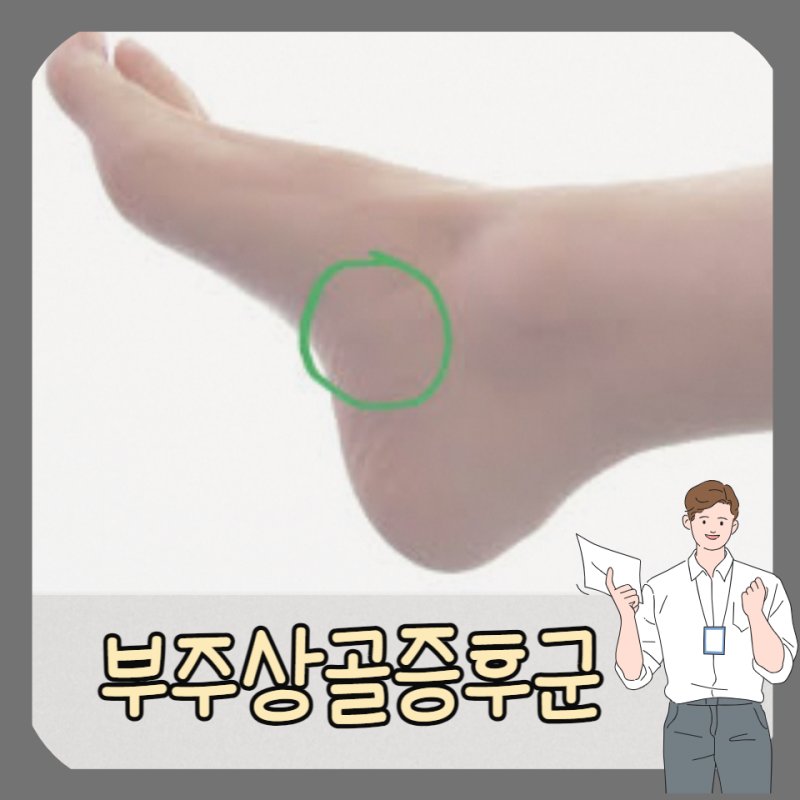 부주상골증후군 수술을 해야 할까 원인과 증상에 대해 알아보자 네이버 블로그