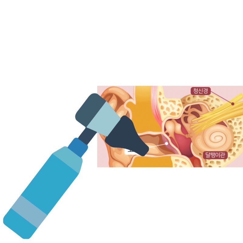중이염 중이염 증상 중이염 원인 치료 급성 중이염 삼출성 중이염 만성 중이염 네이버 블로그