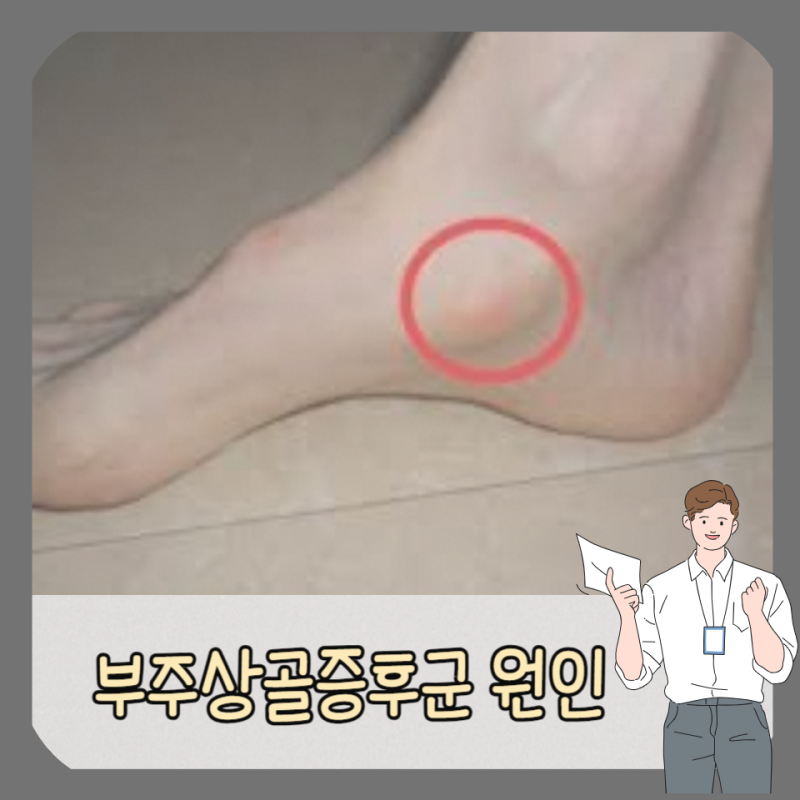 부주상골증후군 수술을 해야 할까 원인과 증상에 대해 알아보자 네이버 블로그
