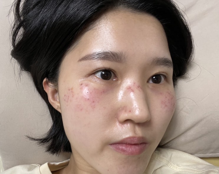 마포 공덕역 근처 주근깨 제거 잡티제거 아리아레이저피코토닝 받으러 갔다2회차 후기공덕역피부과