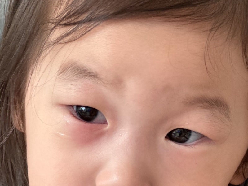 눈꼽감기 눈 밑 부음 아기 결막염 눈 충혈 비비기 붓기 안약 네이버 블로그