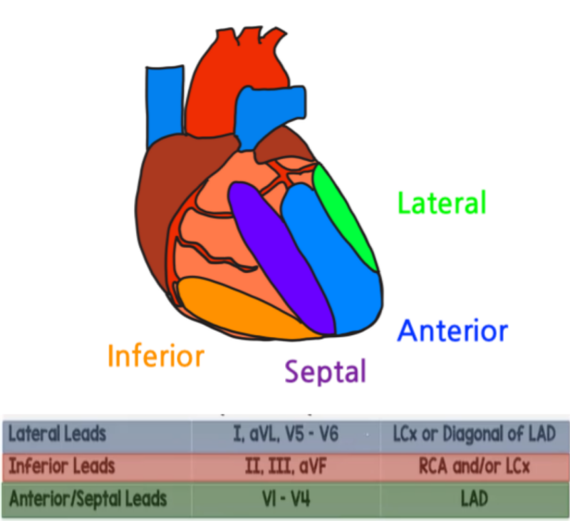 ST 분절 상승 심근경색(STEMI : ST elevation myocardial infarction) : 12 lead ECG ...