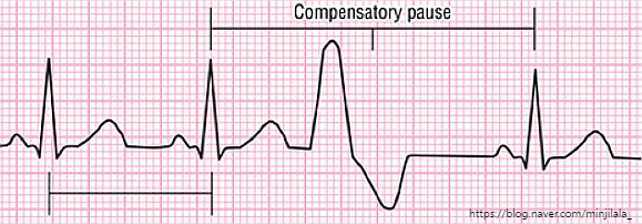 심실조기수축 심실조기박동 PVC VPC premature ventricular complex 심전도 증상 종류 원인 시술 치료 ...