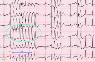 심실조기수축 심실조기박동 PVC VPC premature ventricular complex 심전도 증상 종류 원인 시술 치료 ...