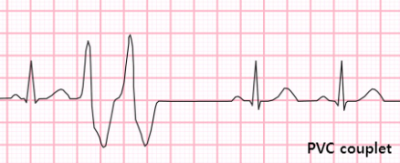 심실조기수축 심실조기박동 PVC VPC premature ventricular complex 심전도 증상 종류 원인 시술 치료 ...