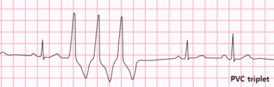 심실조기수축 심실조기박동 PVC VPC premature ventricular complex 심전도 증상 종류 원인 시술 치료 ...