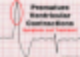 심실조기수축 심실조기박동 PVC VPC premature ventricular complex 심전도 증상 종류 원인 시술 치료 ...
