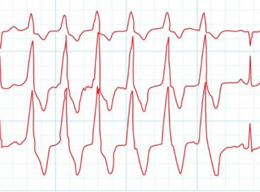 심실조기수축 심실조기박동 PVC VPC premature ventricular complex 심전도 증상 종류 원인 시술 치료 ...