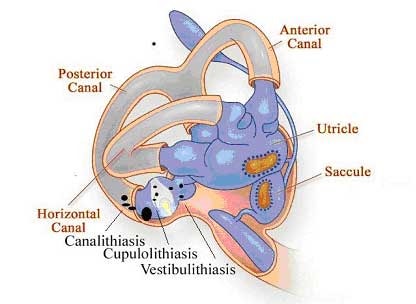 의학용어 BPPV(Benign paroxysmal positional vertigo) 어지러워요. : 네이버 블로그