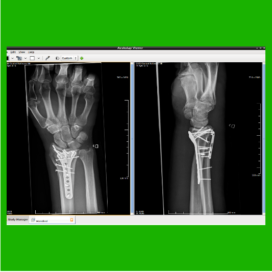 ORIF Distal Radius Fracture 수술 개방정복내부고정술 : 네이버 블로그