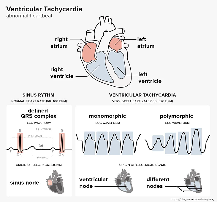 심실빈맥 VT Vtach ventricular tachycardia 원인 증상 심전도 종류 치료 (+pulseless VT ...