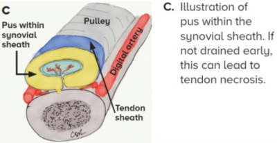 [수부] 손의 감염 : 감염성 건막염 Kanavel's Sign (Infectious pyogenic flexor ...