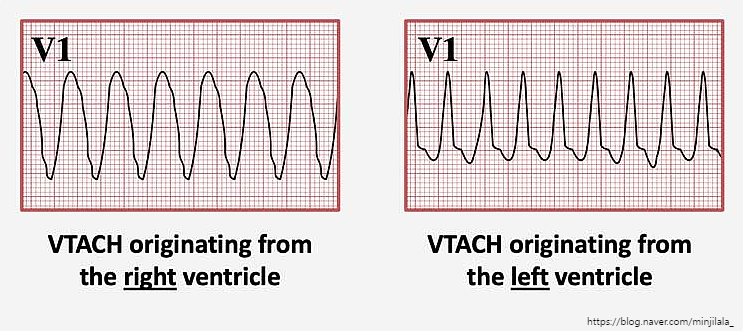 심실빈맥 VT Vtach ventricular tachycardia 원인 증상 심전도 종류 치료 (+pulseless VT ...