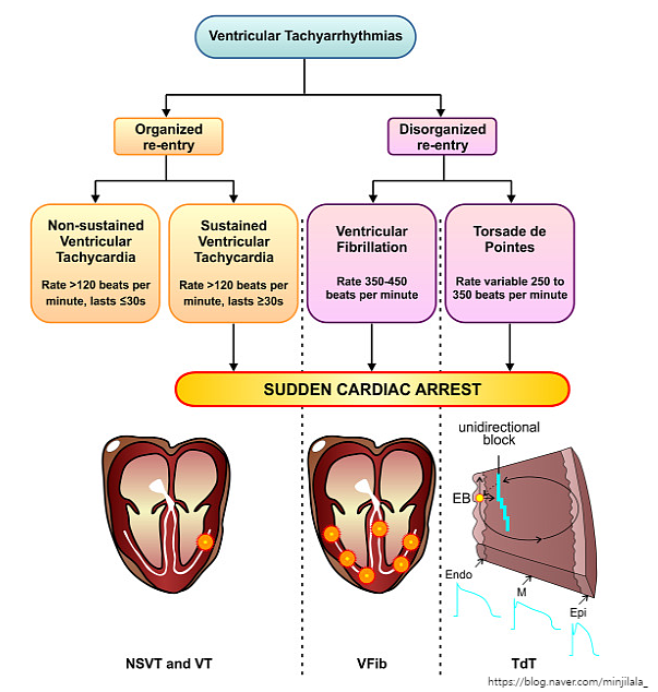 심실빈맥 VT Vtach ventricular tachycardia 원인 증상 심전도 종류 치료 (+pulseless VT ...