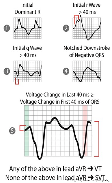 심실빈맥 VT Vtach ventricular tachycardia 원인 증상 심전도 종류 치료 (+pulseless VT ...