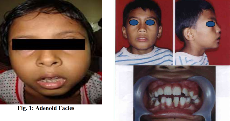 뮤잉운동(혀운동) 효과? 제대로 알고 해야합니다. : 네이버 블로그