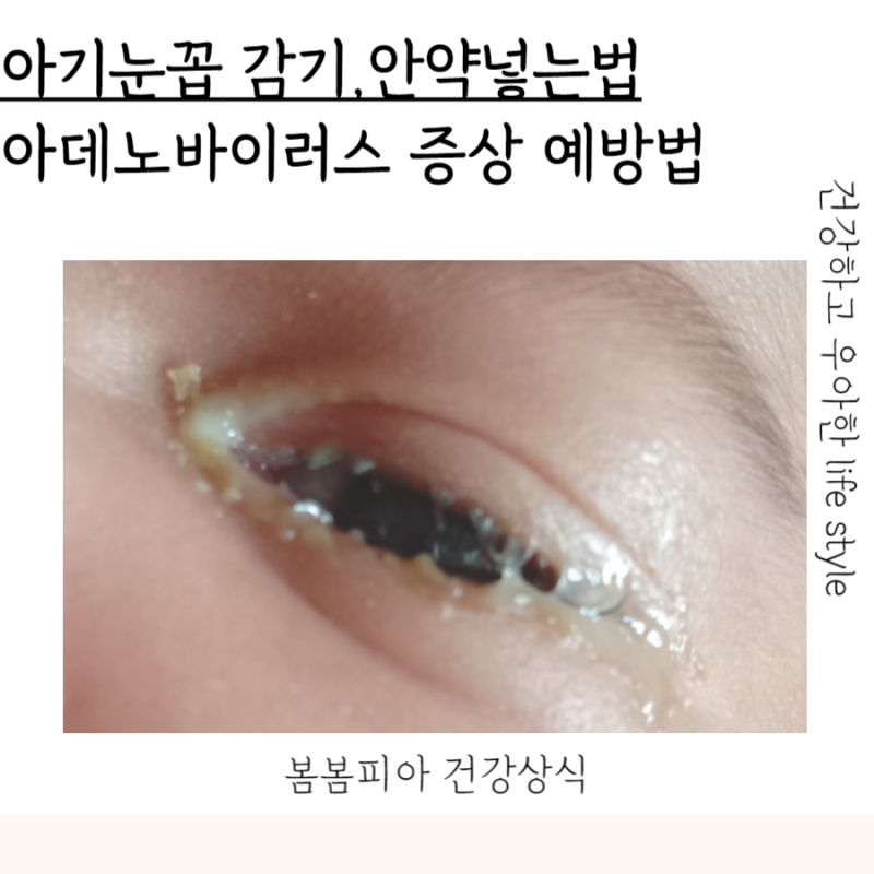 아기 눈꼽감기 아데노바이러스 증상기침전염안약 넣는법 네이버 블로그