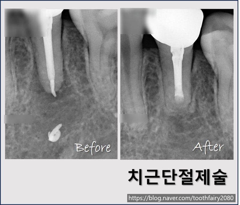 자연치아 살리기 신경치료한 치아가 부었어요ㅣ염증 재발ㅣpart2 치근단절제술 네이버 블로그