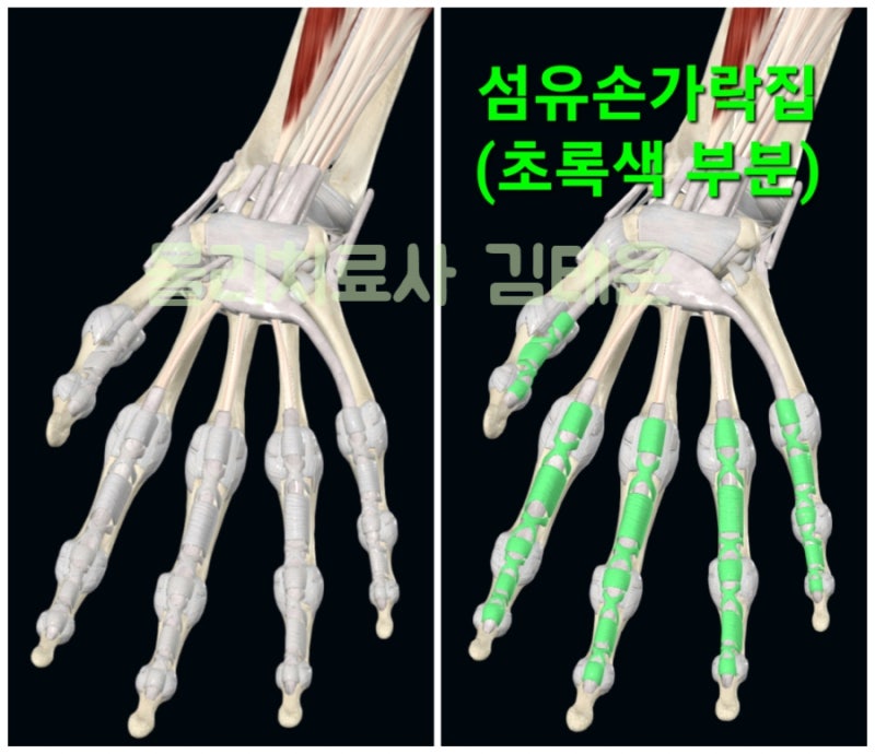 방아쇠수지증후군trigger Finger 손가락 딸깍 소리 원인 및 치료 방법 네이버 블로그
