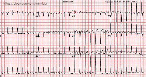 발작성상심실성빈맥 PSVT paroxysmal supraventricular tachycardia 특징 증상 심전도 치료 ...