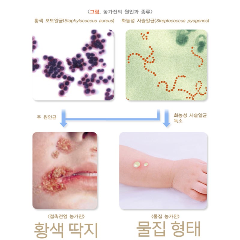 유아 농가진 전염 증상 아기 농가진 연고 어린이집 네이버 블로그