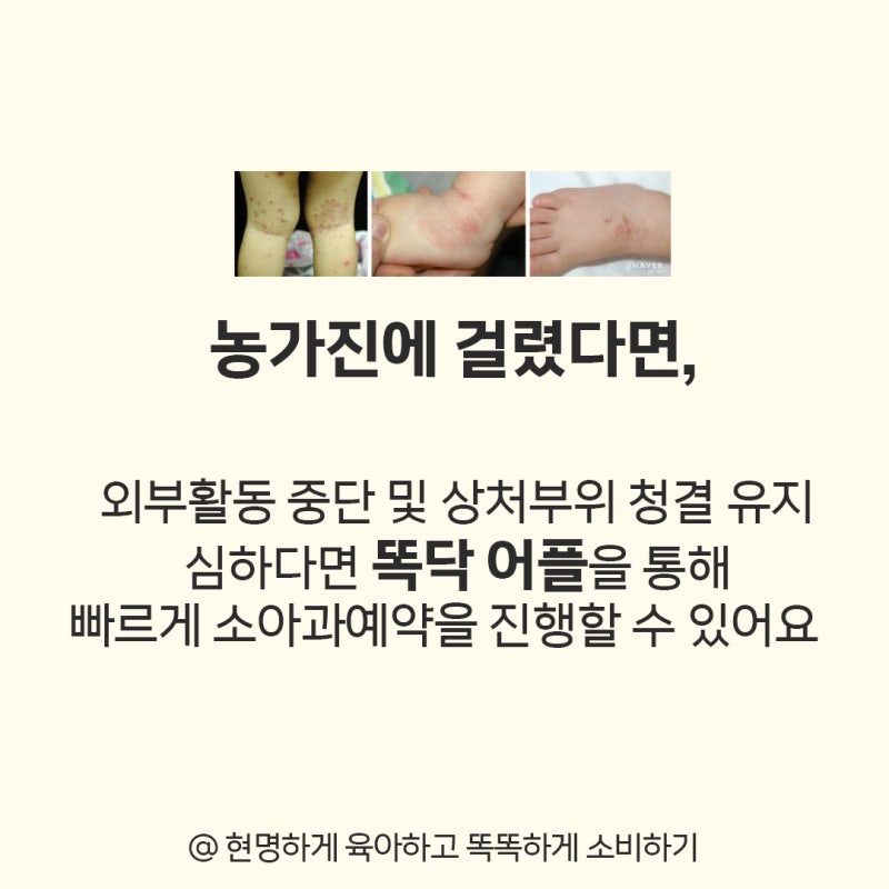 유아 농가진 전염 증상 아기 농가진 연고 어린이집 네이버 블로그