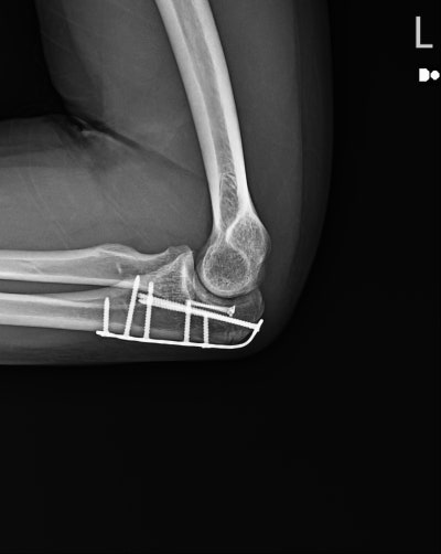 심한 팔꿈치 통증 분쇄가 심한 관절 내 주두 골절 Comminuted Intra Articular Olecranon
