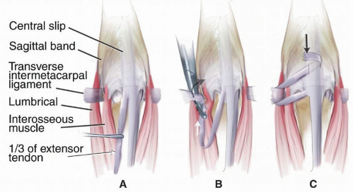 [정형외과 전문의] 신전건 파열, Extensor tendon injury (수부외과) : 네이버 블로그