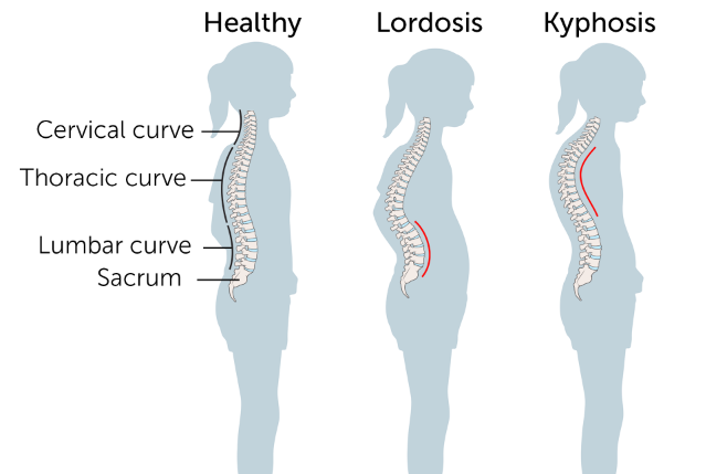 아동 및 청소년의 척추 전만증 Lordosis in Children : 네이버 블로그