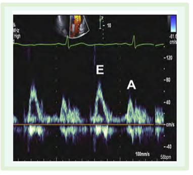 TTE 의학용어 echo 검사 결과 해석 RWMA EF E/e' 의미 Transthoracic Echocardiography ...