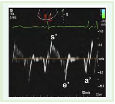 TTE 의학용어 echo 검사 결과 해석 RWMA EF E/e' 의미 Transthoracic Echocardiography ...